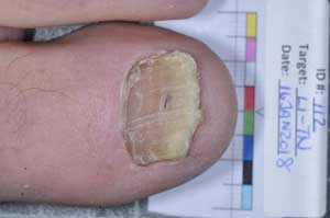 Toenail Fungus Study – Mediprobe Research Inc.